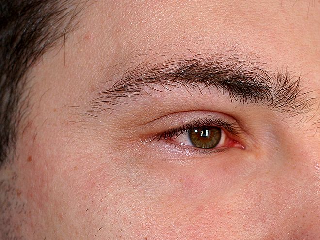 Inflammation de l’œil | HYLO© EYE CARE