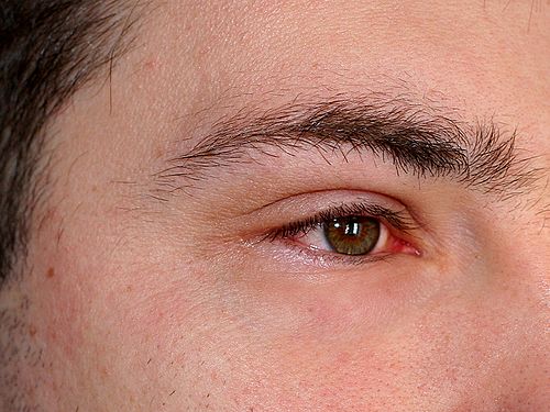 Inflammation de l’œil | HYLO© EYE CARE